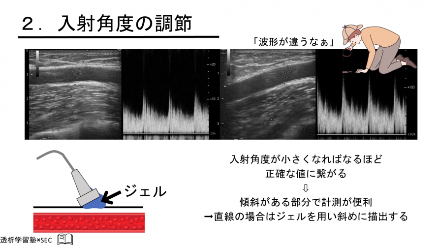 シャントエコーの基礎知識 -形態評価と機能評価- | Peatix